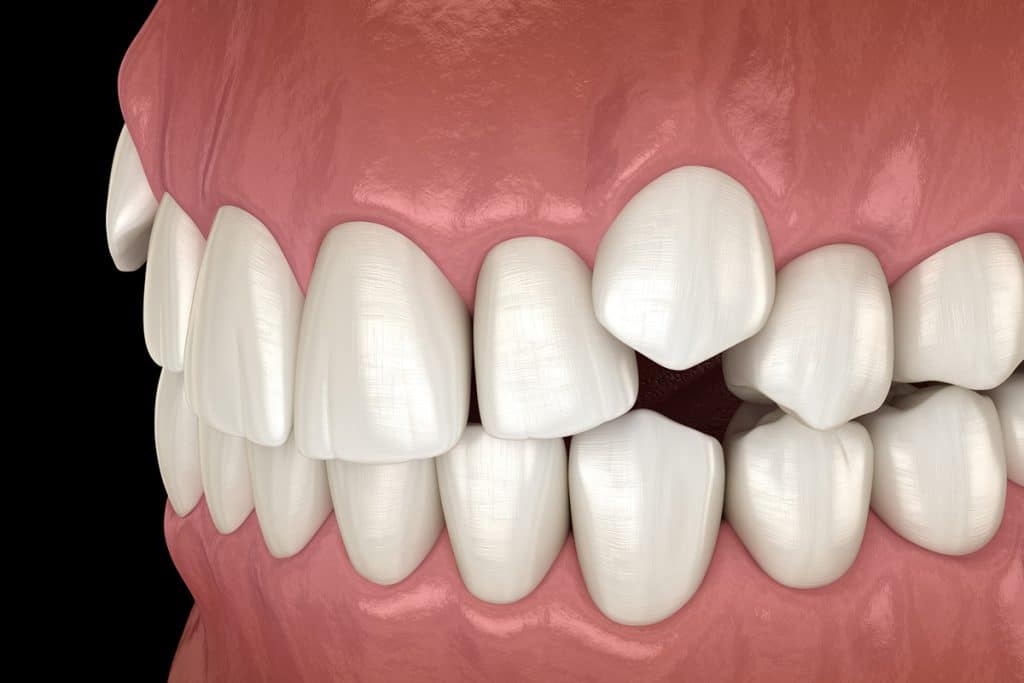 Oral Surgery for Impacted Canines - True North Oral Surgery & Implants
